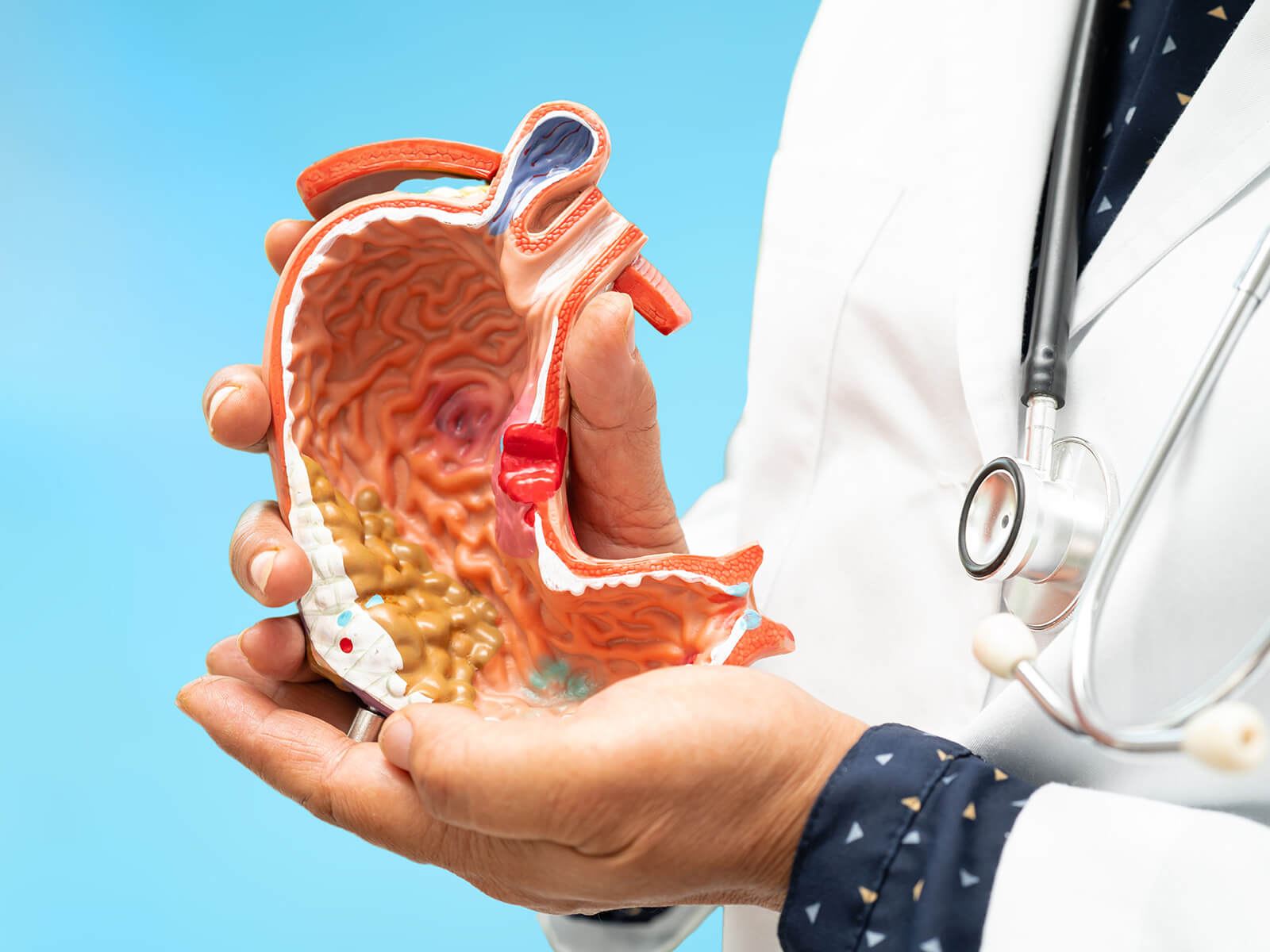 Peptic Ulcer Disease: Causes, Symptoms & Treatment | GastroDoxs